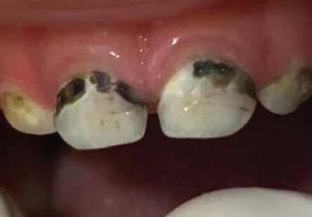 SDF only application (no step 2)